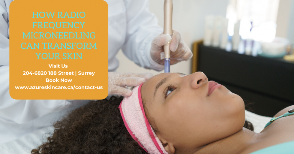 How Radio Frequency Microneedling Can Transform Your Skin - Azure Skin ...